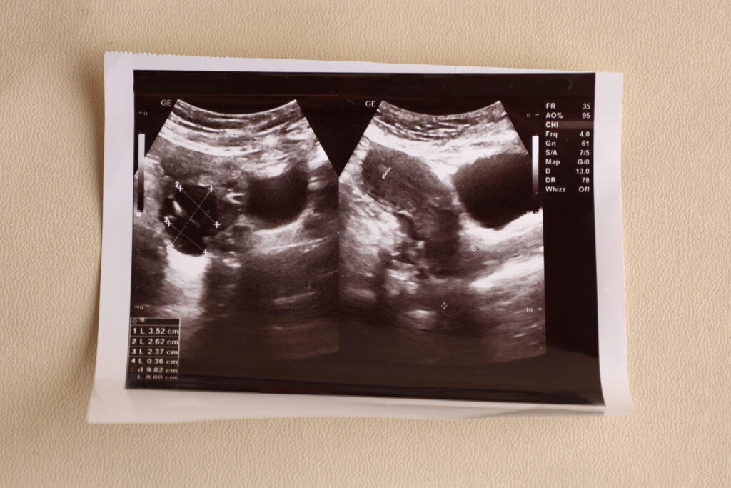 Ovarian Cysts - Dr Sam Daniels